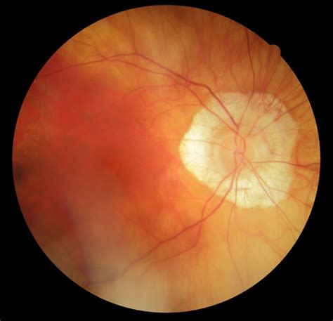 Retinal Abnormalities Gp Eyes