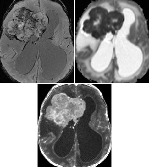 Ependymoma