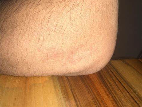 Post Scabies R Scabies