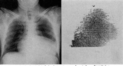 Figure 3 From Detection Of Pericardial Effusion By Radioisotope Heart Scanning Semantic Scholar