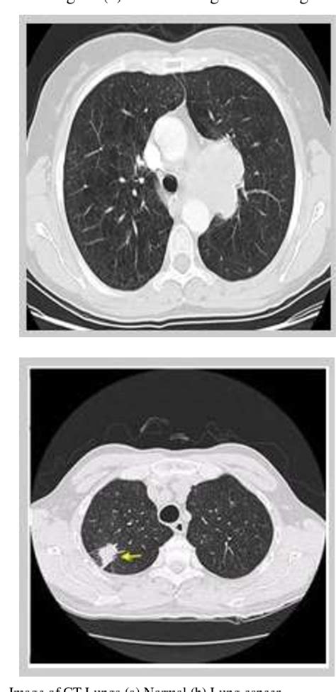 Figure 1 From Lung Nodule Detection In Ct Scan Image Based On Glcm And Rlm Features Using