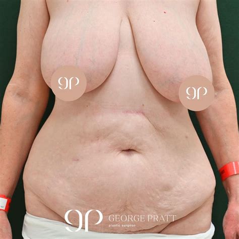 Breast Reduction Overview — Gp