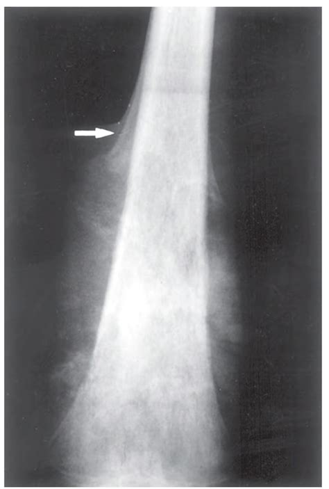 Osteosarcoma X Ray Codmans Triangle