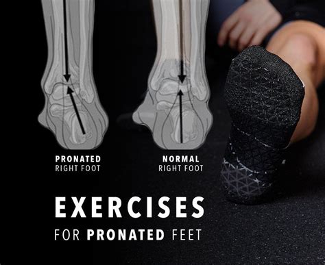 Exercises To Correct Foot Pronation