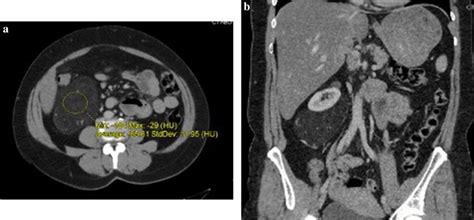 Ct Scan From Case 1 Demonstrates A Tumor In The Right Retroperitoneum