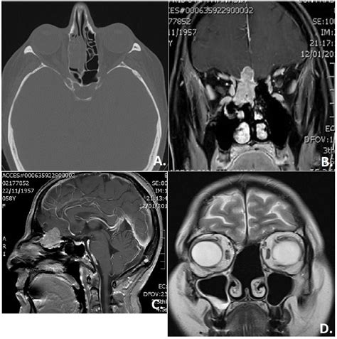 Olfactory Neuroblastoma