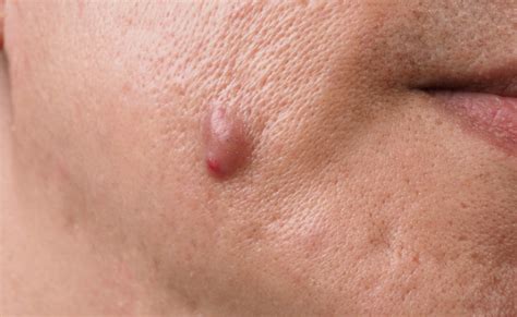 Actinomycosis Causes Symptoms And Effective Treatment