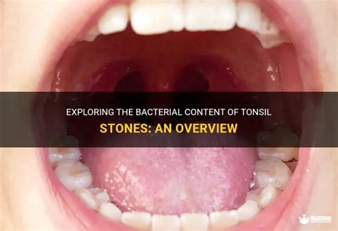 Exploring The Bacterial Content Of Tonsil Stones An Overview Medshun