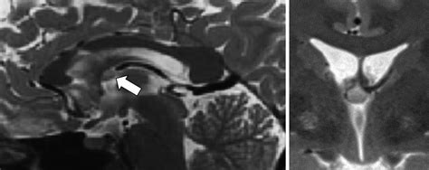 Endoscopic Removal Of Recurrent Colloid Cysts In Journal Of