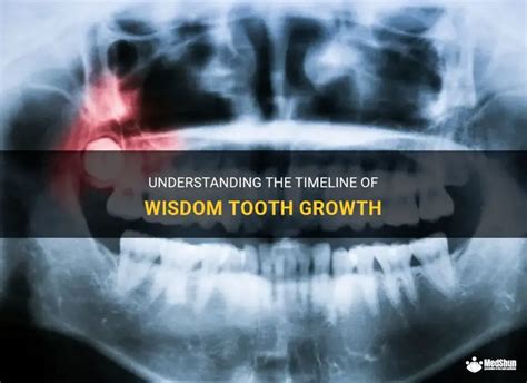Understanding The Timeline Of Wisdom Tooth Growth Medshun