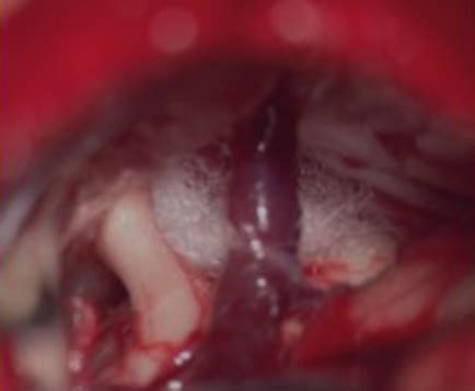 Case Study Trigeminal Neuralgia Current Treatment Strategies Briz Brain Spine