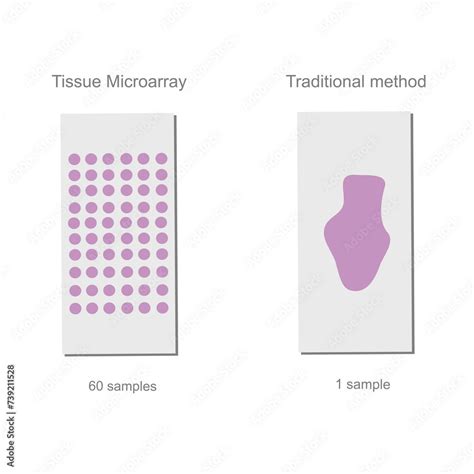 The Technique Comparison Between Traditional Method And Tissue Microarray Tma For Target