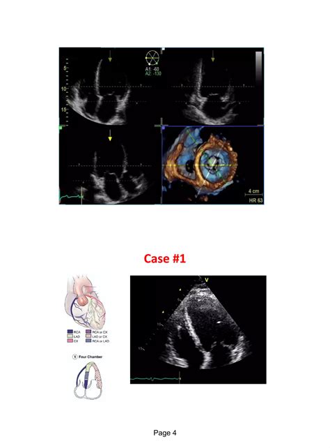Echo In Ischaemic Heart Disease And Myocardial Infarction Pdf