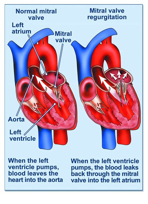 Mitral Valve Mitral Regurgitation Overview Cardiosmart