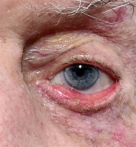 Ectropion Symptoms Causes And Treatments