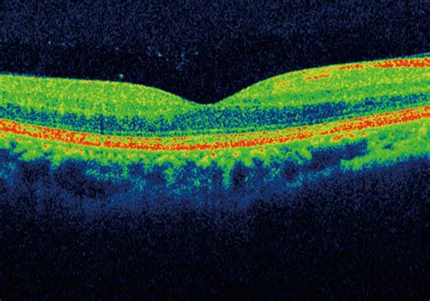 Oct 3d Scanning Eye Design Opticians