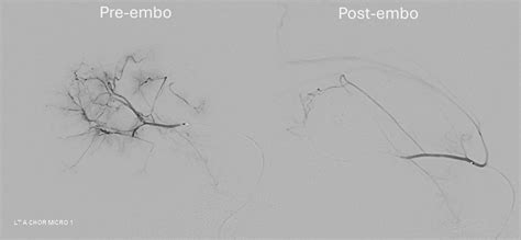 Choroid Plexus Papilloma Preoperative Embolization