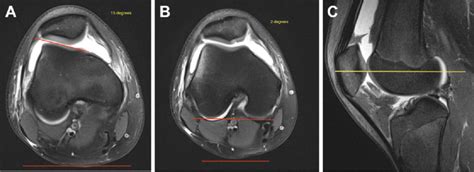 Measurement Technique For 2 Image Lateral Trochlear Inclination Lti Download Scientific