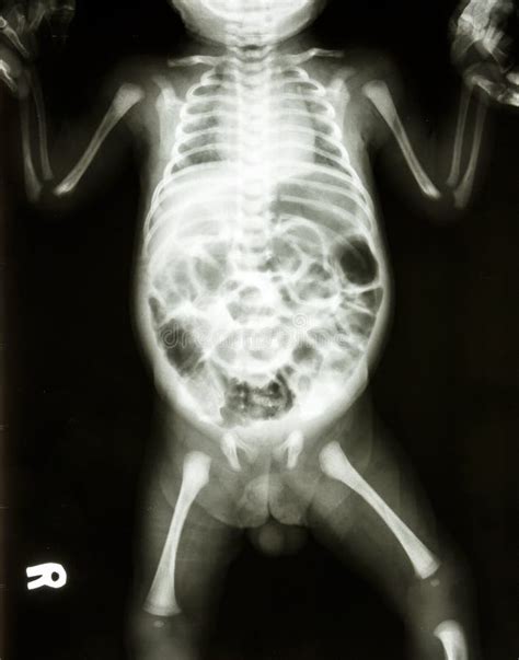 Normal Skeleton Of Infant Stock Image Image Of Investigation