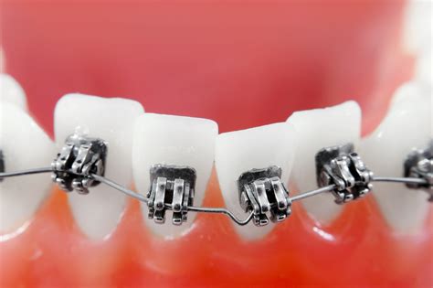Types Of Malocclusion And How They Can Be Treated Reddick Orthodontics