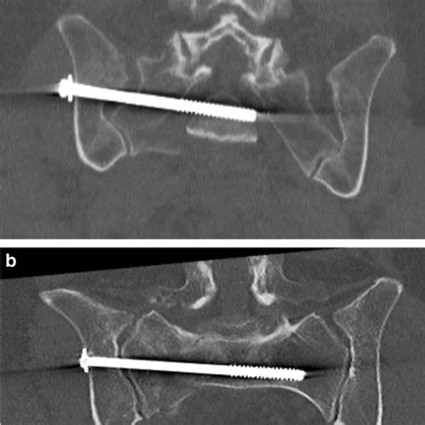 A Postoperative CT Scan In A Year Female With A Lateral Compression Download Scientific