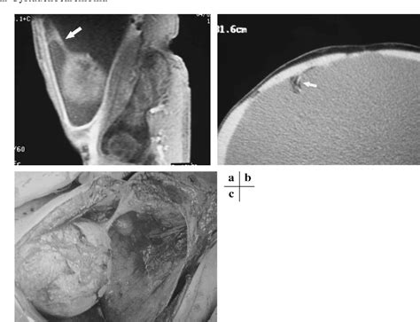 Figure 3 From Mucinous Cystadenocarcinoma Of The Urachus Associated With Pseudomyxoma Peritonei