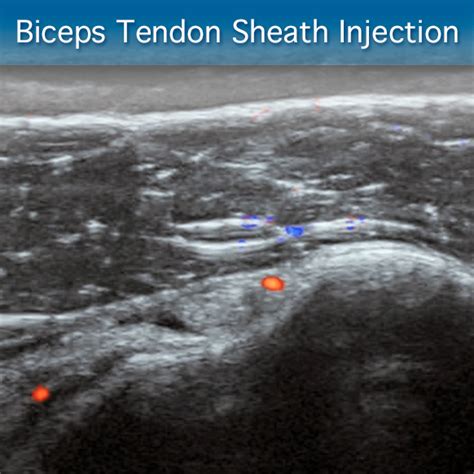Biceps Tendon Sheath Injection Procedure Module Sonosim