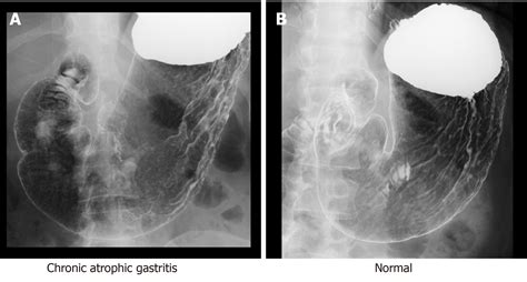 Chronic Atrophic Gastritis Detection With A Convolutional Neural
