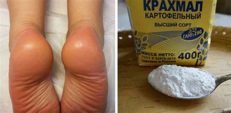 რამდენიმე ხალხური რეცეპტი ქუსლების კანის დასარბილებლად რჩევები ვივიენისგან