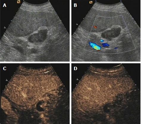 Gallbladder Ultrasound Cancer