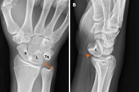 Lunate Dislocation