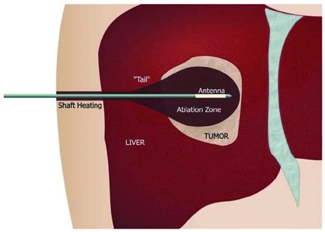 Microwave Ablation Schematic The Microwave Antenna Is Made Up Of An