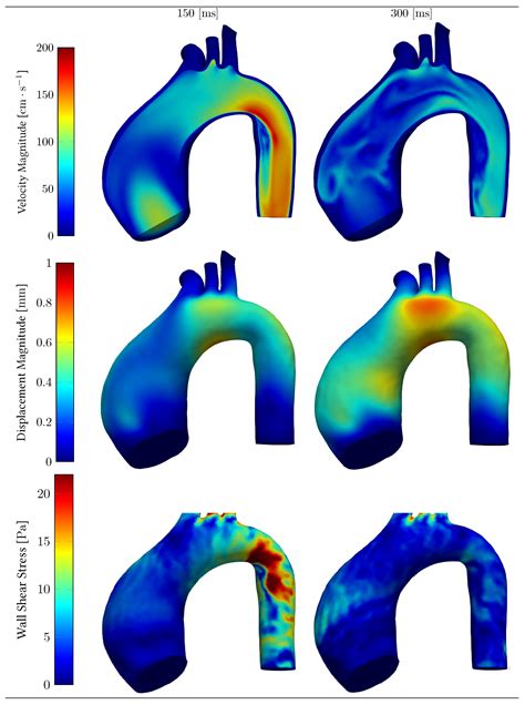 Fluid Structure Interaction Modeling Of Ascending Thoracic Aortic