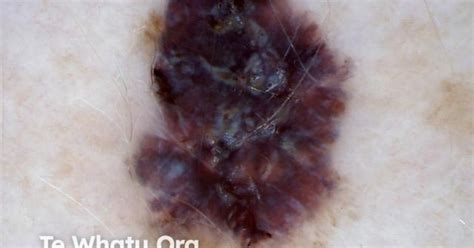 Superficial Spreading Melanoma Breslow 025 Mm Polarised Dermoscopy