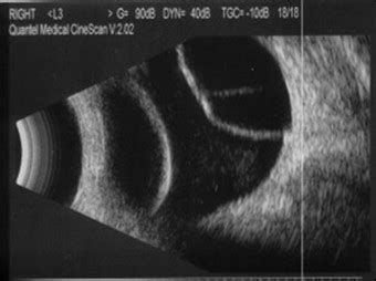 B Scan Ultrasonography And Ubm 910 Westmead Eye Manual