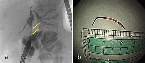A Cholangiogram Showing An Elongated Filling Defect In The Bile Duct