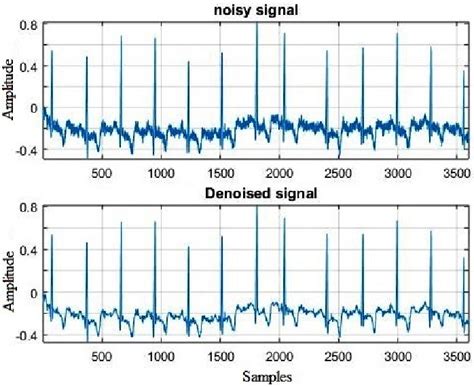 Figure 1 From Csd Optimized Dwt Filter For Ecg Denoising Semantic Scholar