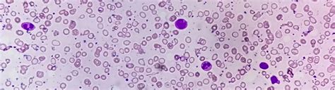Microcytosis Causes Symptoms Diagnosis And Treatment