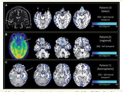 Figure 3 From Seizure Onset Zone Localization Using Postictal Hypoperfusion Detected By Arterial
