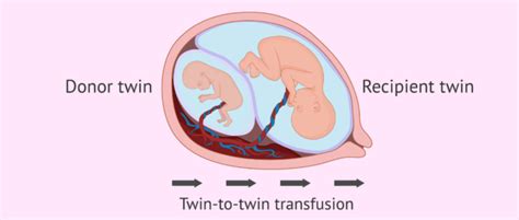 Vanishing Twin Syndrome Bleeding