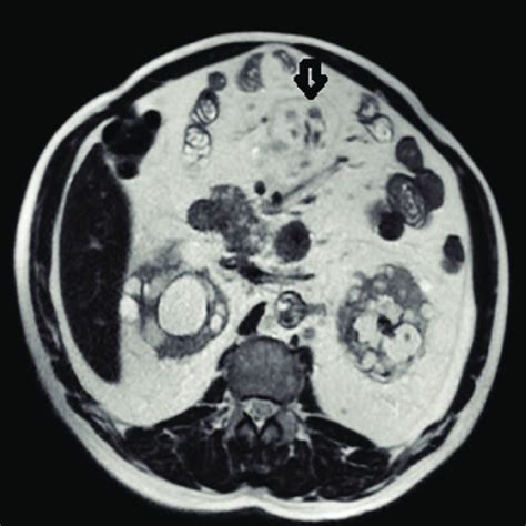 An Axial Ct Image Shows A Mesenteric Panniculitis With A Fibrotic Band