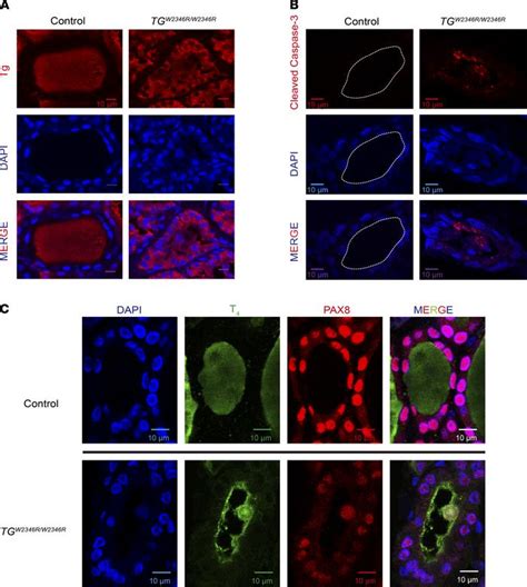Jci Insight Thyroid Hormone Synthesis Continues Despite Biallelic Thyroglobulin Mutation With