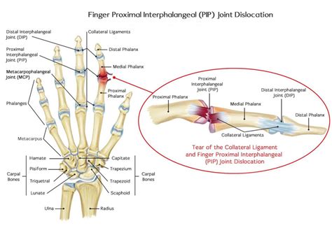 Dislocations Of The Pip Joint Symptoms Causes Treatment By Wrist