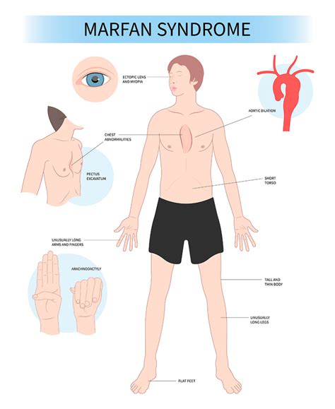 Sindrome De Marfan O Que E Causas Sintomas Diagnostico Tratamento