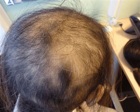 Telogen Effluvium Recovery Priyas Successful Treatment Story