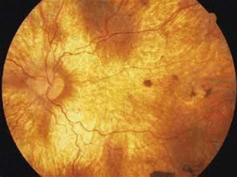 Degeneration And Atrophy Of The Choroid Ento Key