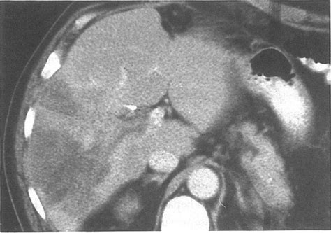 Computed Tomographic Scan Depicting An Abnormal Wedge Shaped