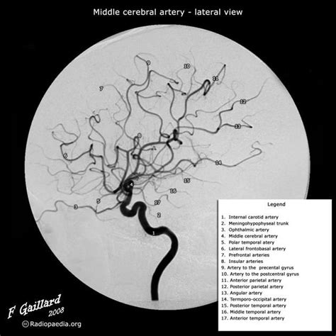 Middle Cerebral Artery Artofit