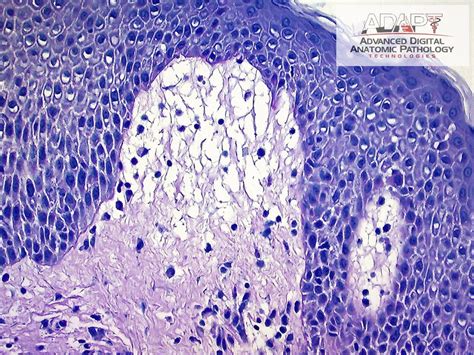 Polymorphous Light Eruption Histology