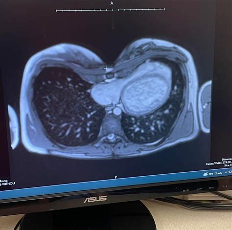 Haller Index 4 0 And 34 R Pectusexcavatum